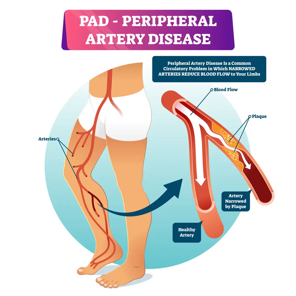Poor Blood Circulation, Peripheral Artery Disease • Milton ...