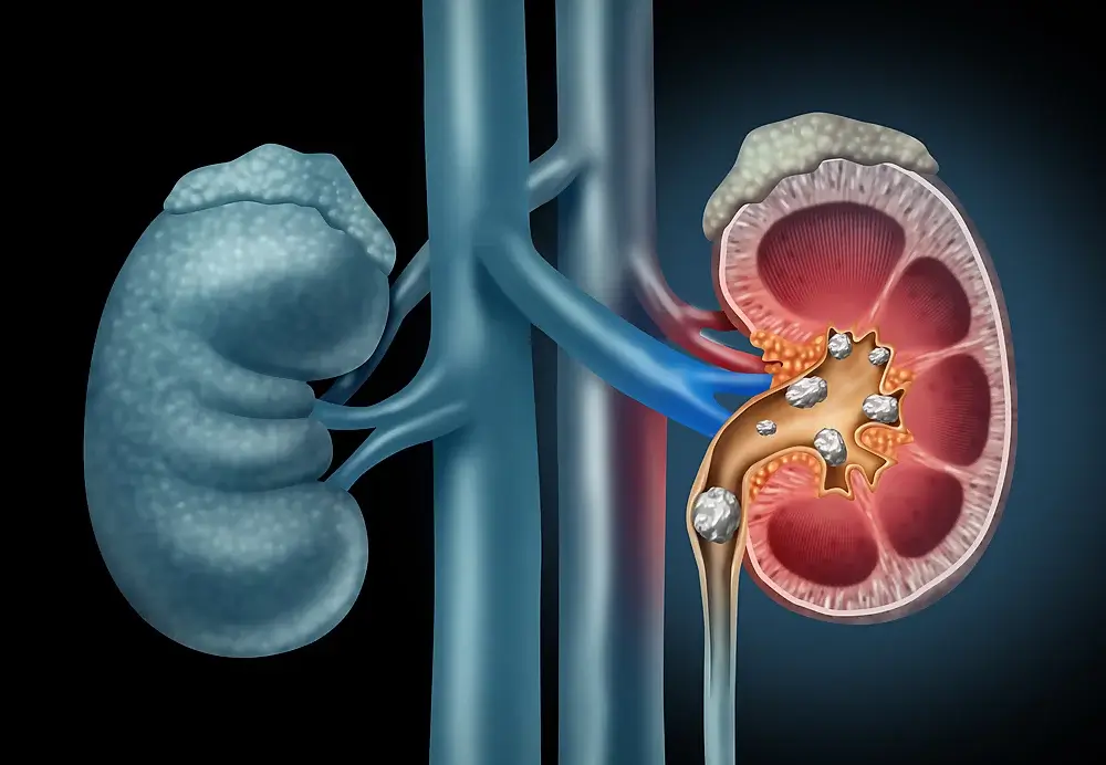 Kidney Stones • Mississauga • Naturopath • Natural Health Clinic of Halton